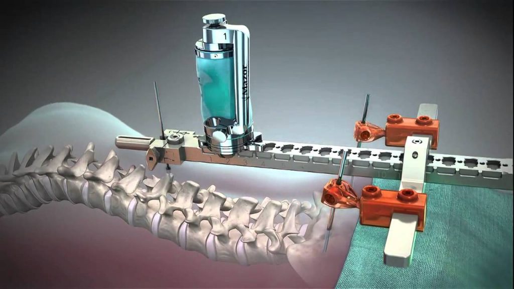 Medtronic übernimmt Mazor Robotics | inVISION