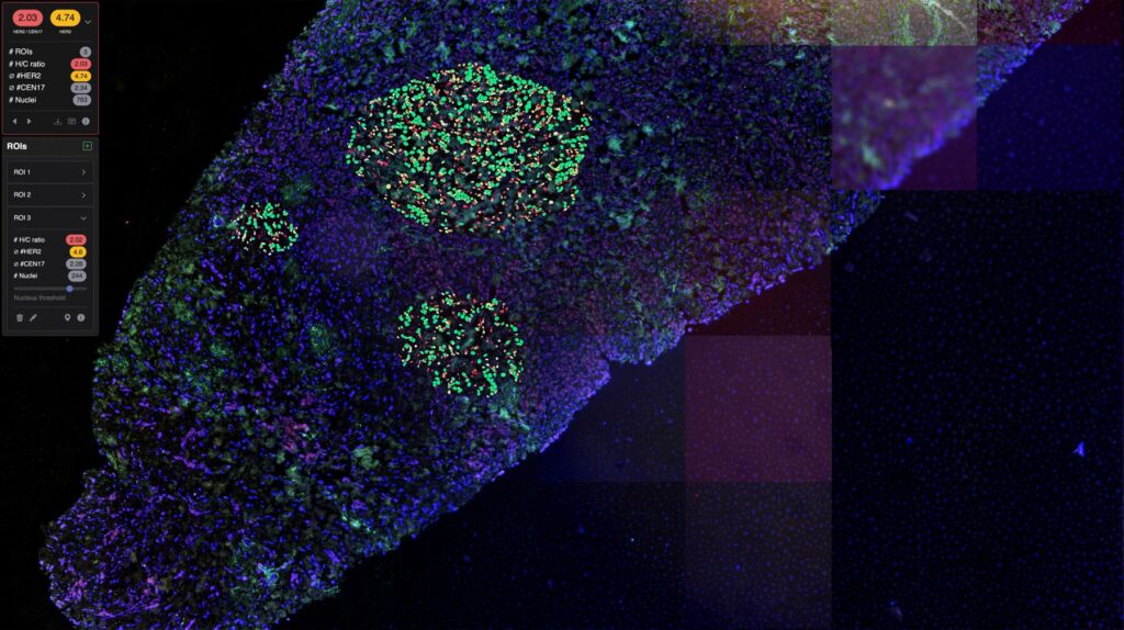 AI to fight cancer - inVISION